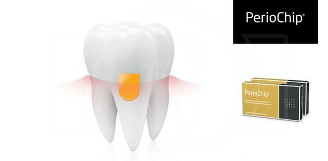 PerioChip – эффективное средство для лечения пародонтоза – полезные ...